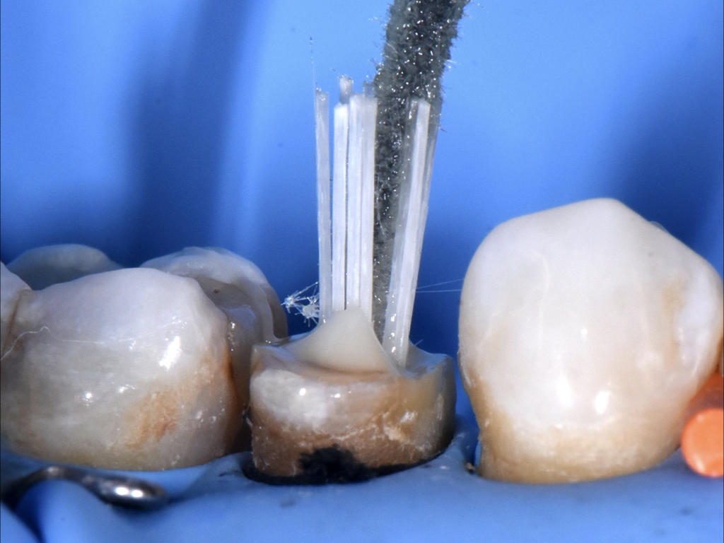 Un innovador poste radicular ayuda a preservar la sustancia dental