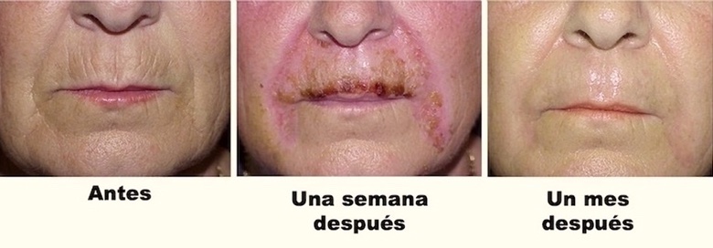 El rejuvenecimiento del labio superior (4)